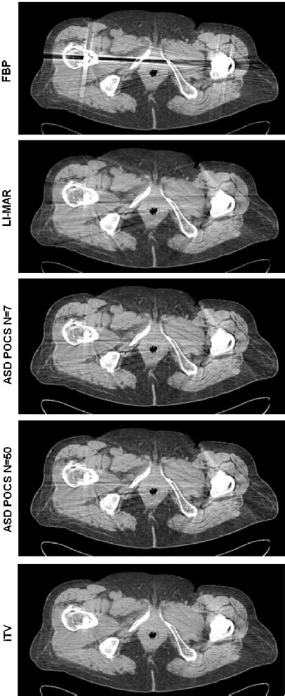 The Upper Image Shows An Fbp Filtered Backprojection Reconstruction Download Scientific