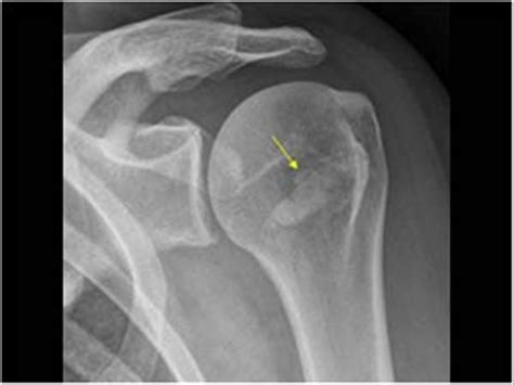 Musculoskeletal Joints And Tendons 6 1 Shoulder Case 6 1 6 Rotator Cuff Calcific Tendinosis