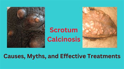 Scrotal Calcinosis Uncovered Causes Myths And Effective Treatments