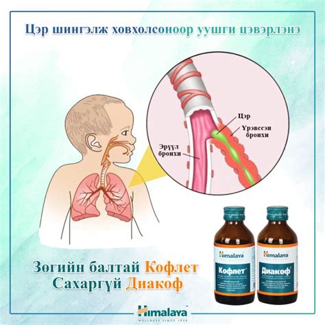 Гуурсан хоолойн бачуурал буюу уушгины бронхитын үеийн гэрээр авах арга