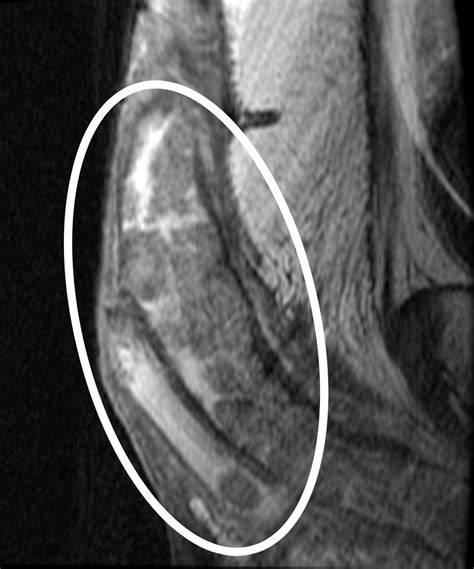 Imaging Of Penile Neoplasms Radiographics Sexiz Pix