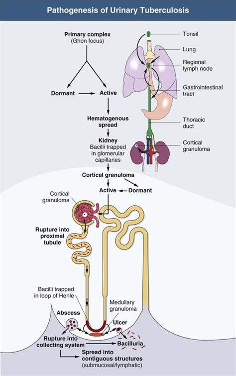 Urogenital Tuberculosis