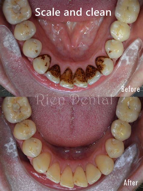 Removal Of Tartar Plaque And Stains On Teeth
