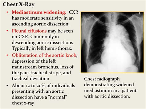 Aortic Dissection X Ray