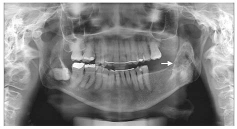 Mandibular Radiolucencies A Differential Diagnosis Of A Rare Tumor Pmc