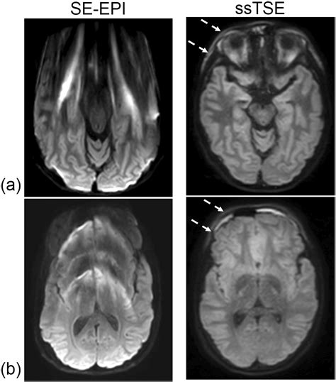 Comparison Of 2d Single Shot Turbo Spin Echo And Spin Echo Echo Planar