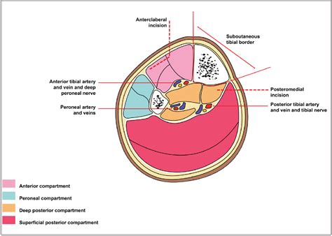 Acute Compartment Syndrome And Fasciotomy Defence Medical Services