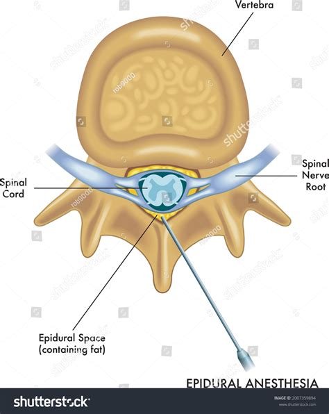 1 759 Epidurals Images Stock Photos Vectors Shutterstock