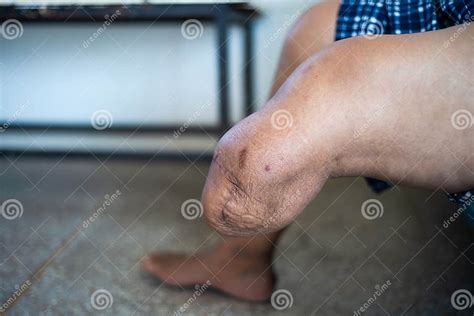 Below Knee Amputation Stump And Muscle Training Stock Image Image Of Patient Healthy 203299717