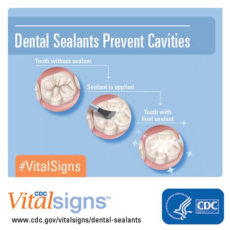Dental Sealants Prevent Cavities Cdc Online Newsroom Cdc