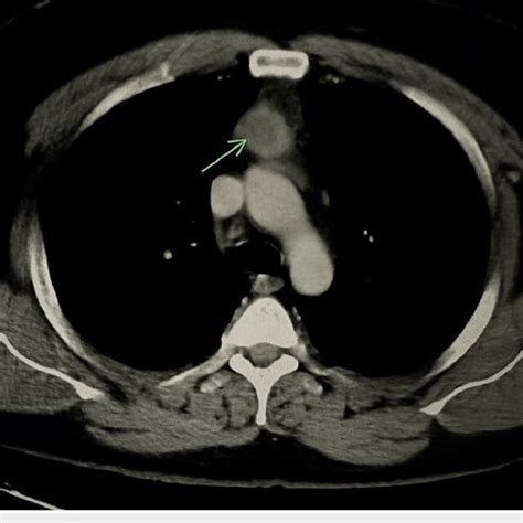 Axial Ct Image Of The Chest Showing The Anterior Mediastinal Mass Ct Download Scientific