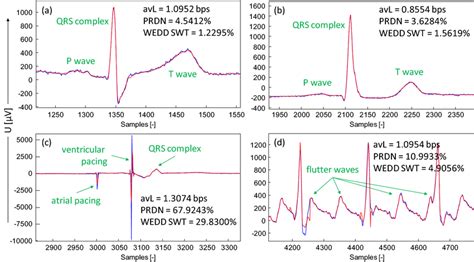 An Example Of Compression Of Ecg Signals Without And With Pathologies