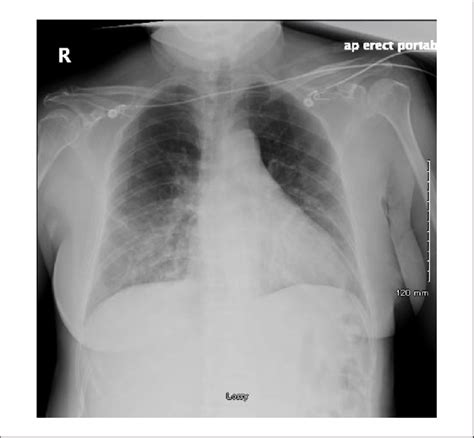 Chest X Ray Showing Bilateral Interstitial Infiltrates Download