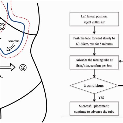 Placement Checklist For Post Pyloric Nutritional Tube Placement Download Scientific Diagram Placement Checklist For Post Pyloric Nutritional Tube Placement Download Scientific Diagram