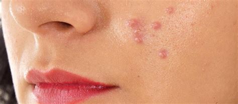 تعرف على كيفية التخلص من حبوب الوجه بسرعة عبر 8 وصفات طبيعية