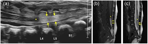 Pediatric Spine Ultrasound Comprehensive Review And Systematic