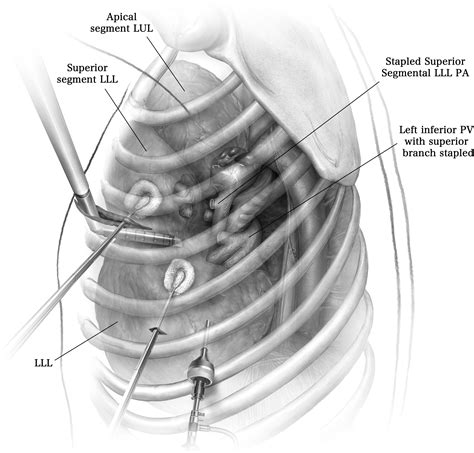 Minimally Invasive Segmentectomy Operative Techniques In Thoracic And