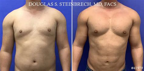 Pectoral Implant Recovery Timeline What Men Can Expect