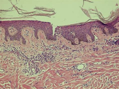 Erythematous Violaceous And Atrophic Patches And Plaques With Sagging