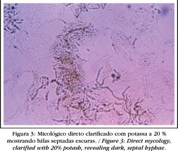 Brasil Tinea Nigra Na Cidade De Santos Relato De Cinco Casos Tinea