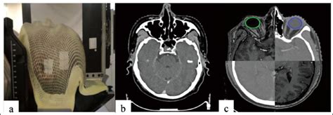 Step By Step Stereotactic Radiotherapy Planning Of Pituitary Adenoma A