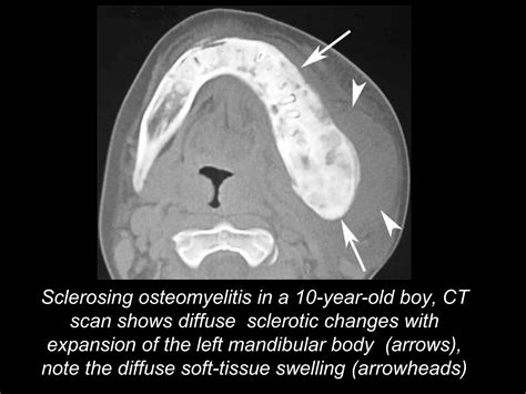 Introduction To Radiological Diagnosis Of Osteomyelitis For