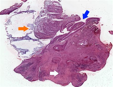 Tympanosclerosis Vs Cholesteatoma