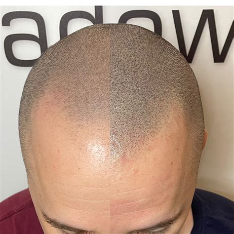 Scalp Micro Pigmentation Gold Coast Scalp Micro Pigmentation Gold Coast