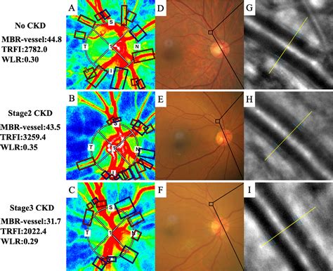 Figure 1 From Relationship Between Retinal Microcirculation And Renal Function In Patients With
