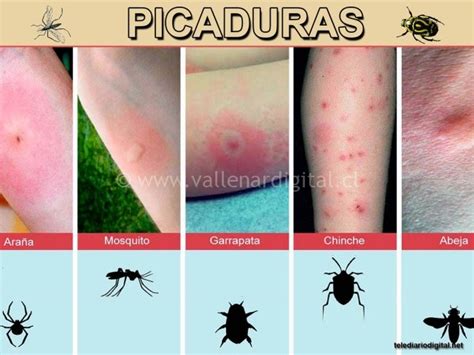 Picadura De Araña Vs Picadura De Chinche