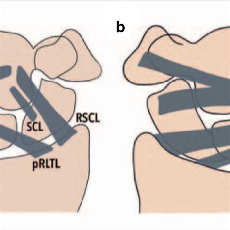 Proposed Algorithm For Scanning Dorsal Wrist Ligaments Licensee Mdpi