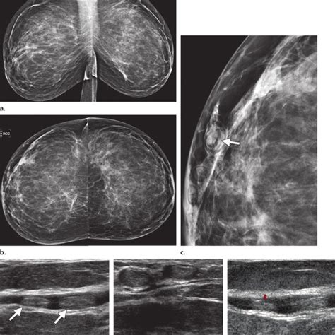 Blocked Ducts In A 38 Year Old Woman With A 2 Week History Of A Right