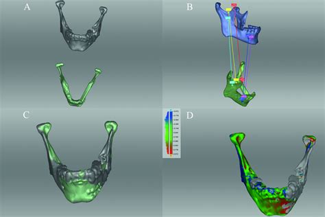 three dimensional surface matching procedure of the corresponding pre