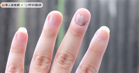 灰指甲預防、治療做對了？防黴菌感染、灰指甲上身，日常保健3要點 華人健康網 專業即時優質的健康新聞及資訊分享平台業即時優質的健康新聞及資訊分享平台