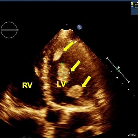 Transthoracic Echocardiogram Apical 4 Chamber View Demonstrates Download Scientific Diagram