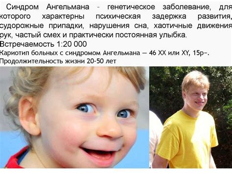 Синдром Вильямса 6 ранних признаков и 4 важных этапа лечения заболевания