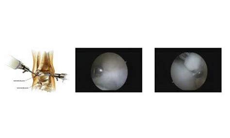 Arthroscopy Of The Ankle Joint Dr George Besiris Orthopedic Surgeon