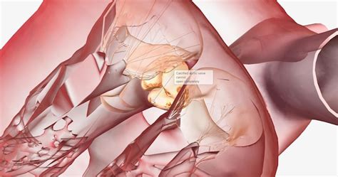 Premium Photo Calcified Aortic Valve Cannot Open Completely