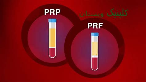 پی آر پی پوست صورت چیست؟ و هزینه پی آر پی صورت با بیمه