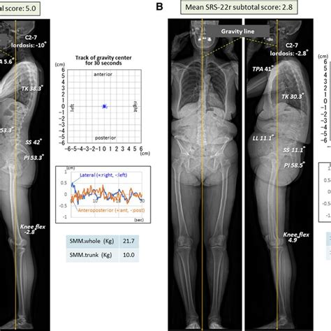 Standing Whole Body Sagittal Alignment Parameters Sva Sagittal Download Scientific Diagram