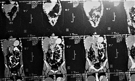Ct Scan Of Abdomen Showing Swollen Appendage In The Subhepatic Region Download Scientific Diagram