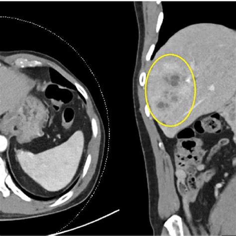 A Ct Scan Of The Abdomen With Intravenous Contrast Showing 9 Cm Download Scientific Diagram