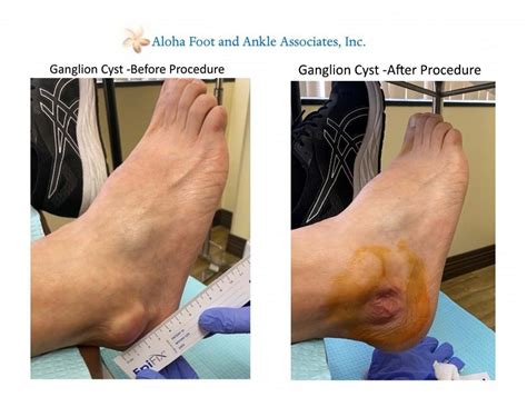 Ganglion Cyst Removal Toe