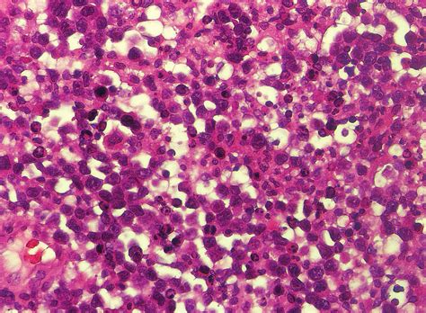 Biopsy Of The Proximal Humerus Revealed Infiltration Of Malignant Cells