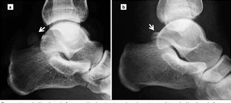 Figure 1 From The Accessory Ossicles Of The Foot And Ankle A