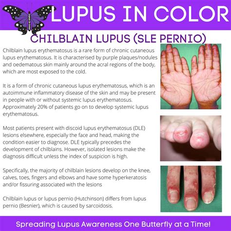 Lupus Chilblain Lupus Erythematosus Is A Rare Form Of Chronic Cutaneous Lupus Erythematosus