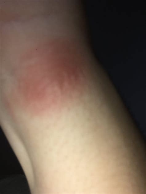 Rash Irritation From Fitbit Sense Sensor R Fitbit