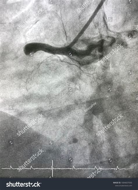 Coronary Angiogram Shown That Massive Thrombus Foto Stok 1684607050