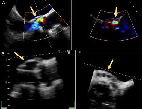 Severe Paravalvular Leak In The Posterior Portion Of The Aortic Download Scientific Diagram
