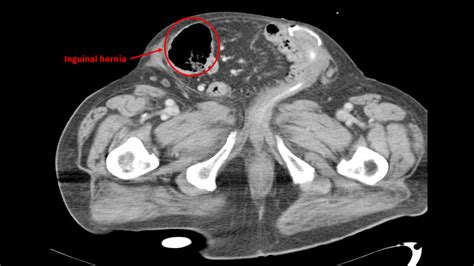 Inguinal Hernia